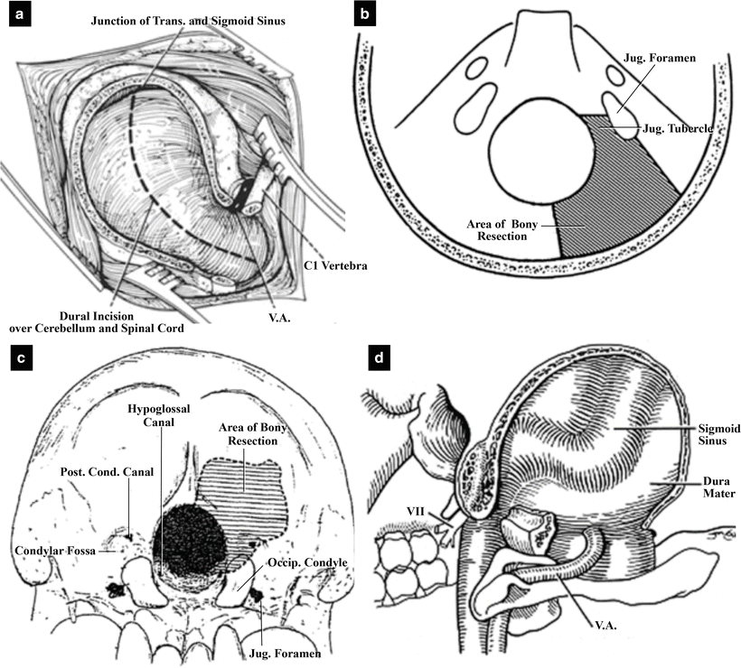 Surgical Anatomy of and Approaches Through the Lateral Foramen Magnum: The Transcondylar Fossa ...