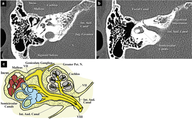 The Temporal Bone: Basic Anatomy and Approaches to Internal Auditory ...