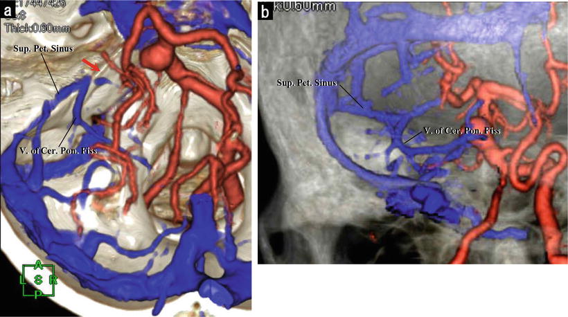 Posterior and Anterior Transpetrosal Approaches | SpringerLink