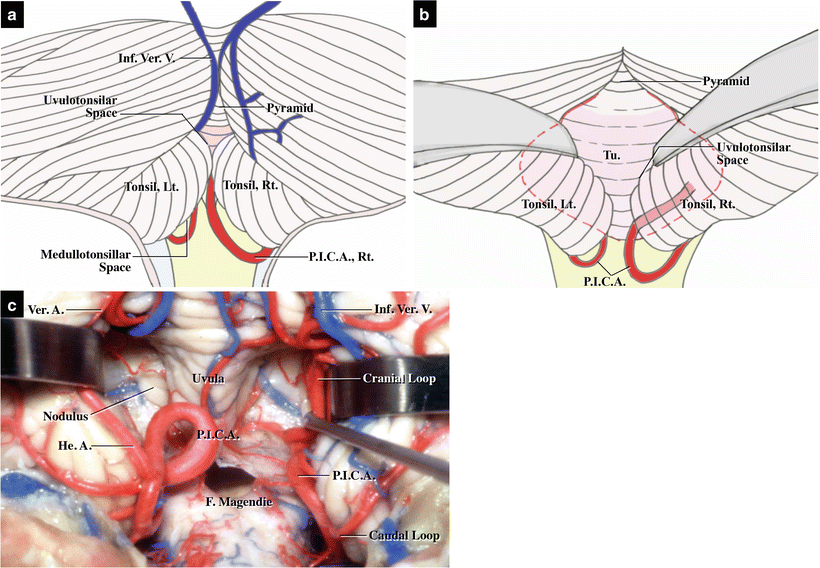 Midline Suboccipital Approach and Its Variations for Fourth Ventricular ...