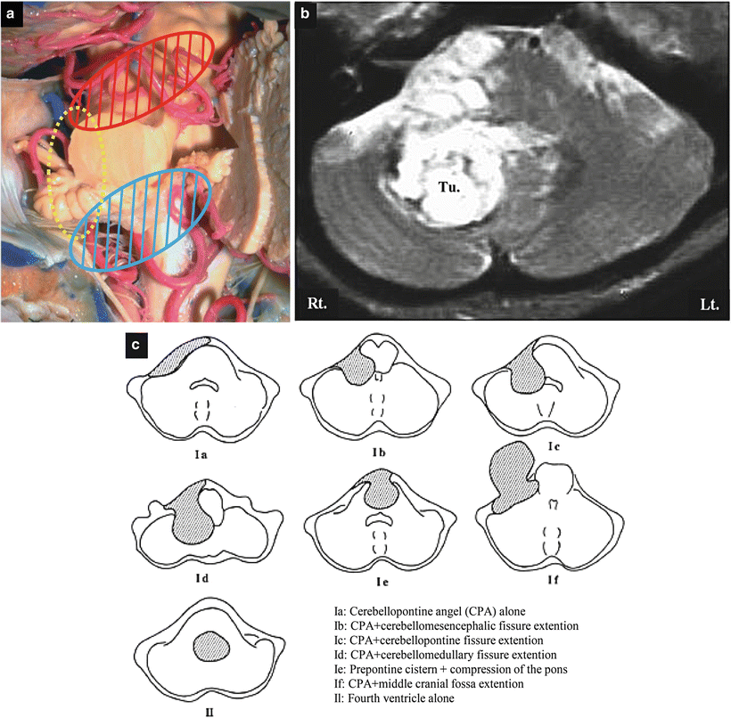 The Retrosigmoid Lateral Suboccipital Approach: Basic Approach and ...