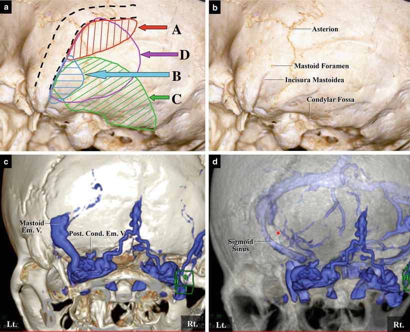 The Retrosigmoid Lateral Suboccipital Approach: Basic Approach and ...