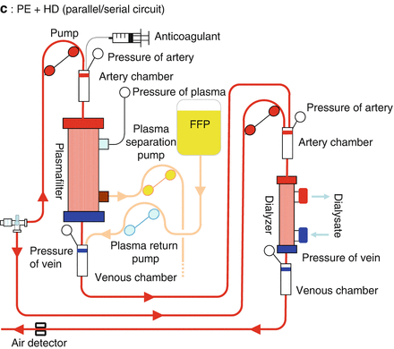 Plasma Exchange | SpringerLink