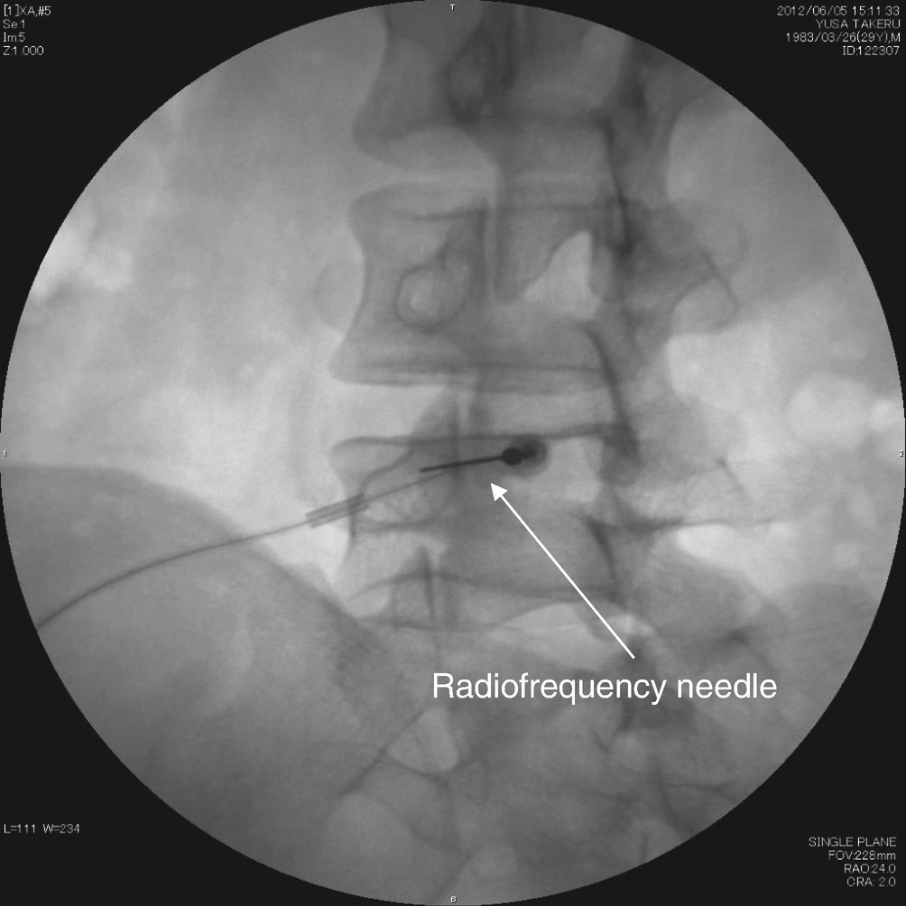 Radiofrequency Thermocoagulation of the Posterior Medial Branch of the ...