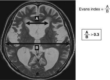 MRI Diagnosis in Other Dementias | SpringerLink