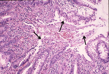 Pathology, Pathogenesis, and Experimental Amebiasis | SpringerLink
