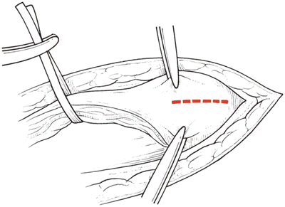 Hydrocele, Nuck Hydrocele: Standard Procedure | SpringerLink