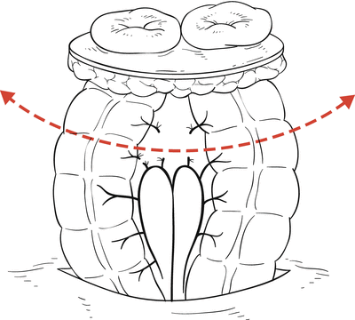 Colostomy: Creation and Closure | SpringerLink