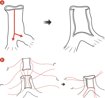 Repair and Anastomosis of the Blood Vessel | SpringerLink