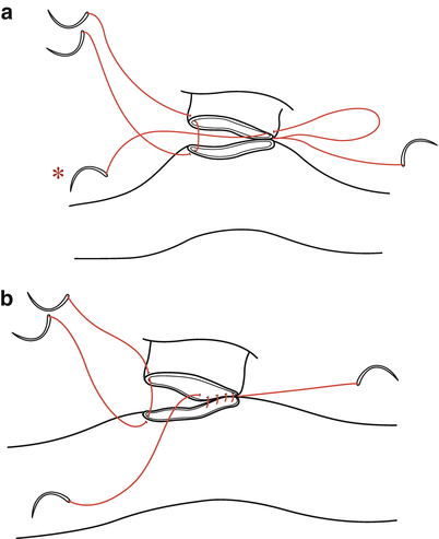 Repair and Anastomosis of the Blood Vessel | SpringerLink