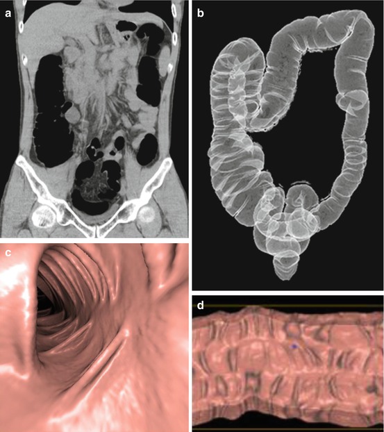 Current Progress of Endoscopy in Inflammatory Bowel Disease: CT ...