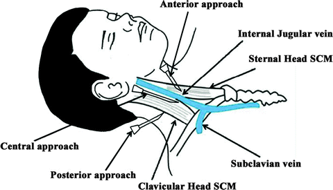 Central Line Placement | SpringerLink