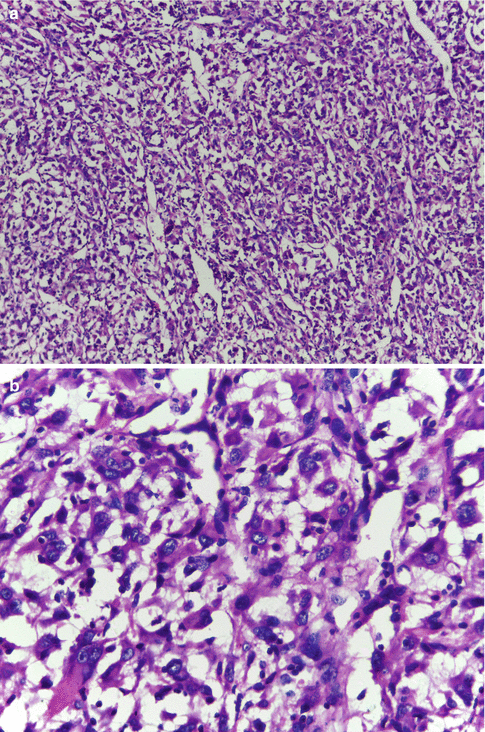 Pathology of Uterine Sarcomas | SpringerLink