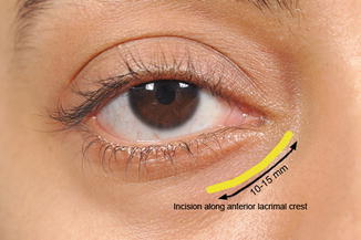 Aesthetic External DCR: The Subciliary Approach | SpringerLink
