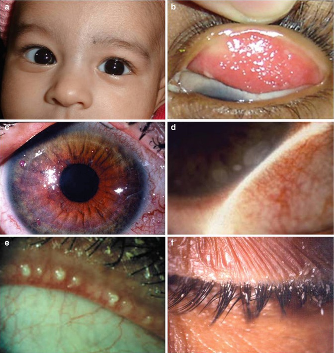 Evaluation of Epiphora | SpringerLink