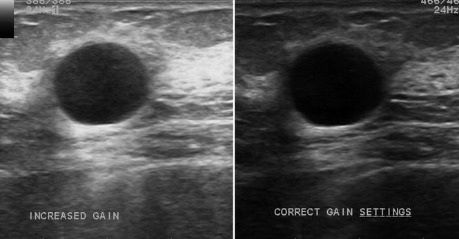 Fibrocystic Change: Involutionary Changes–Breast Cysts | SpringerLink