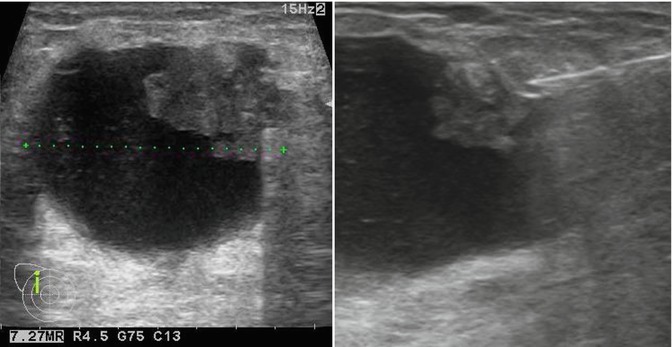 Fibrocystic Change: Involutionary Changes–Breast Cysts | SpringerLink