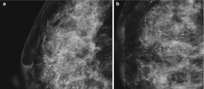 Fibrocystic Change: Involutionary Changes–Breast Cysts | SpringerLink