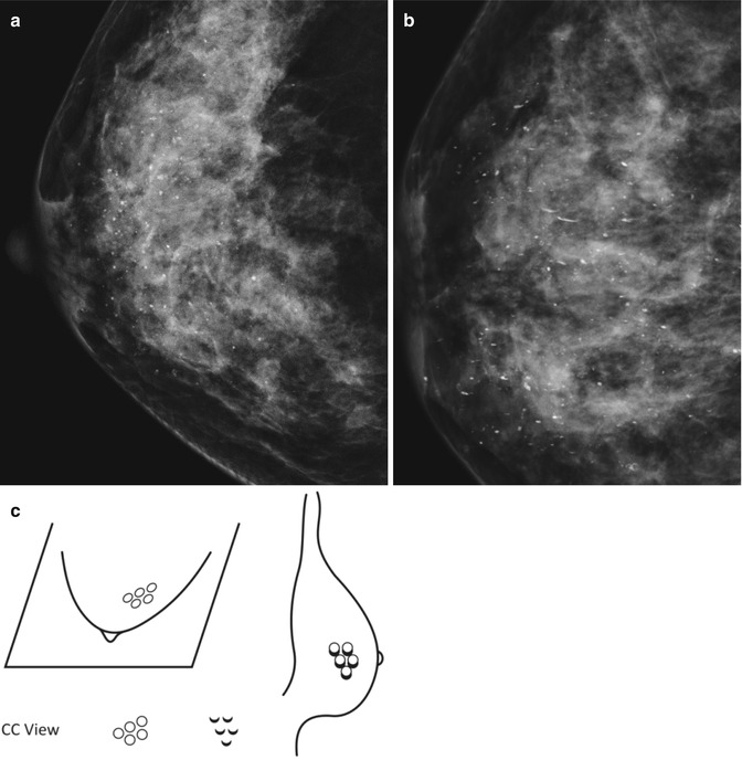 Approach to Calcifications | SpringerLink