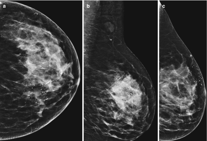 Approach to Calcifications | SpringerLink