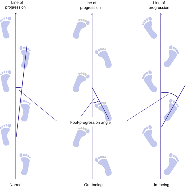 In-Toeing and Out-Toeing Gait | SpringerLink