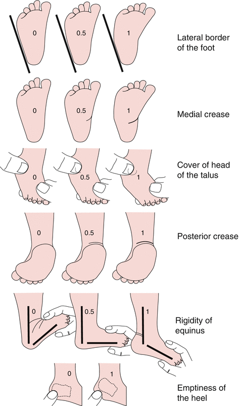 The Inverted Foot | SpringerLink