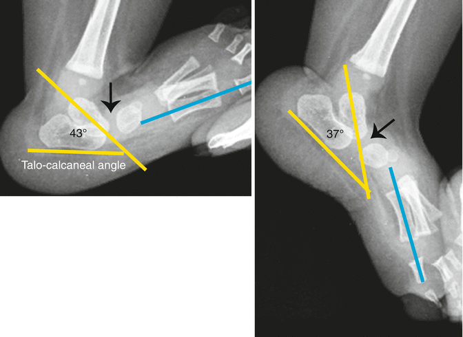 The Everted Foot | SpringerLink