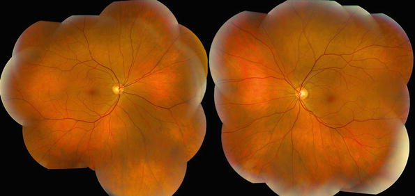 Autoimmune Retinopathy | SpringerLink