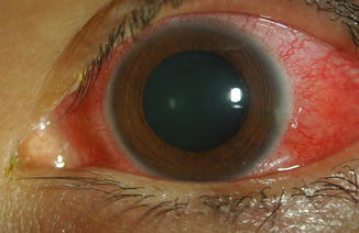 Diffuse Anterior Scleritis | SpringerLink