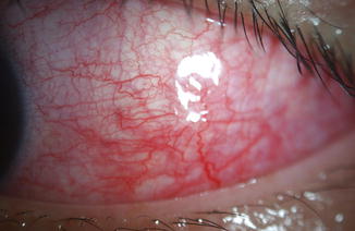 Inflamed Sclera