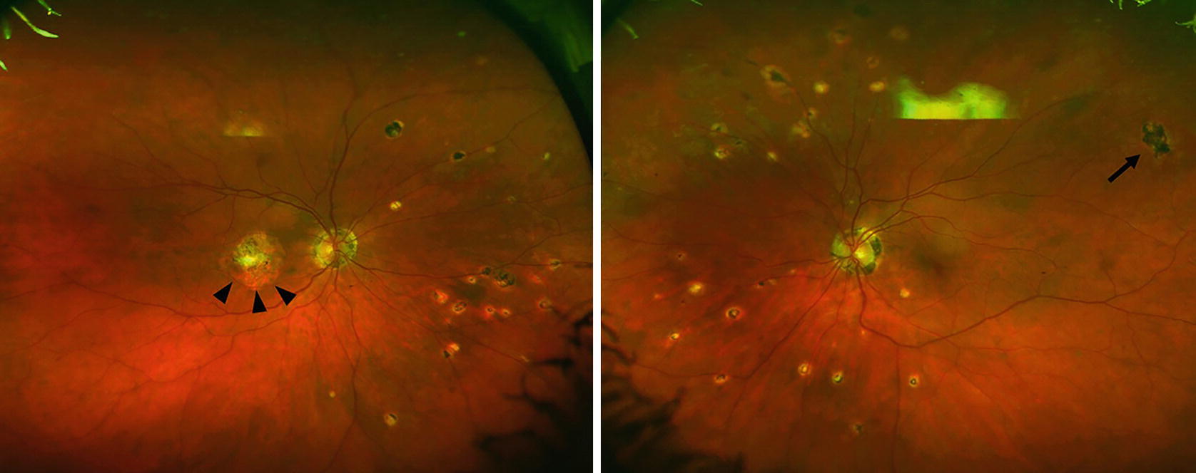 Multifocal Choroiditis | SpringerLink