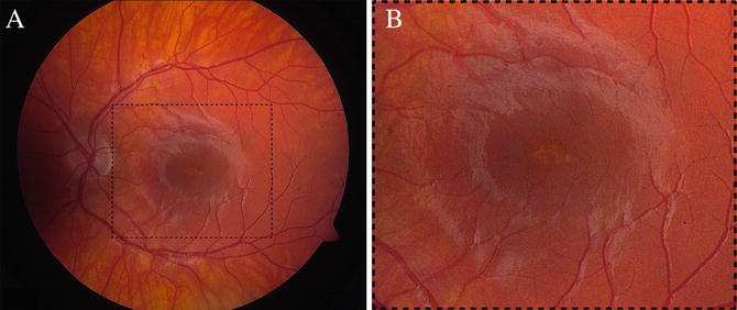 Acute Retinal Pigment Epithelitis | SpringerLink