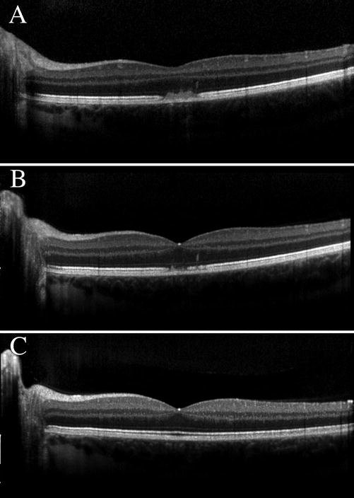 Acute Retinal Pigment Epithelitis | SpringerLink