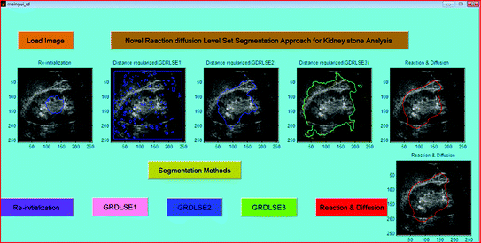 VLSI Implementation and Analysis of Kidney Stone Detection from Ultrasound Image by Level Set ...