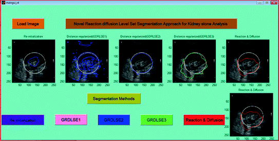 VLSI Implementation and Analysis of Kidney Stone Detection from Ultrasound Image by Level Set ...