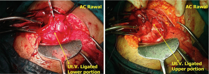 The Lower Segment of Uterus – A Critical Area in Childbirth and ...