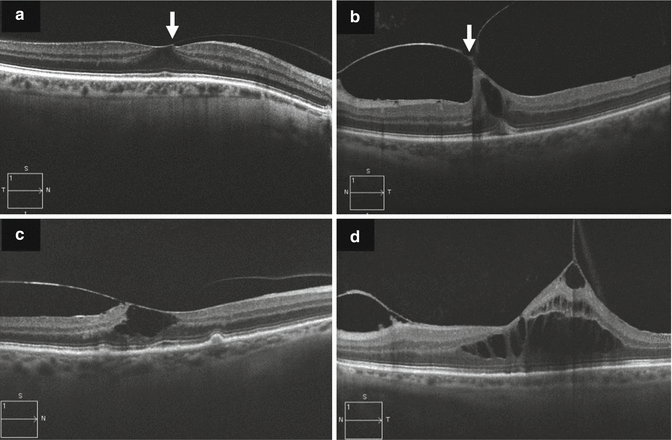 Vitreomacular Traction and Epiretinal Membranes | SpringerLink