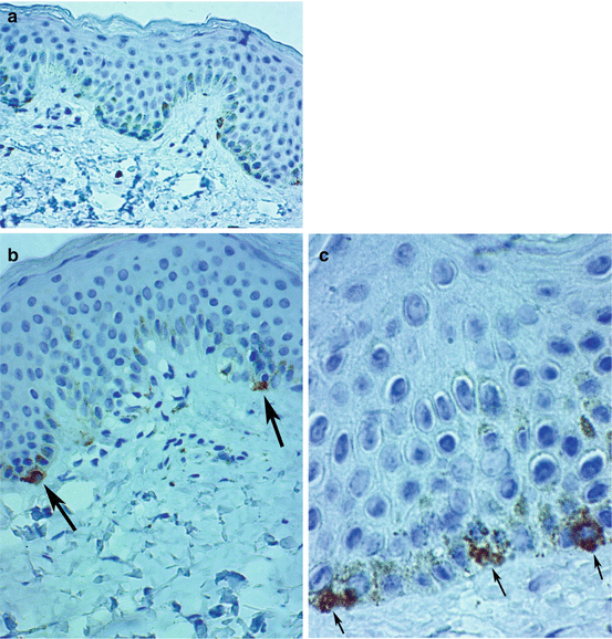 The Histopathology of Vitiligo in Brown Skin | SpringerLink