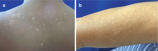 Differential Diagnosis of Vitiligo in Brown Skin | SpringerLink