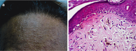 The Histopathology of Melasma in Brown Skin | SpringerLink