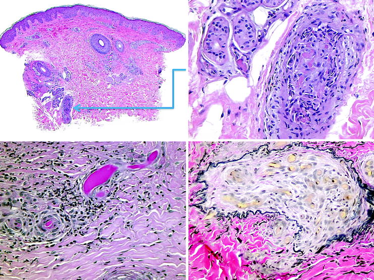 Cutaneous Cryoglobulinemic Vasculitis | SpringerLink