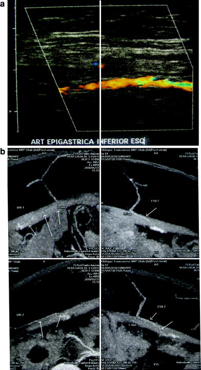 Bipedicled TRAM Flap | SpringerLink