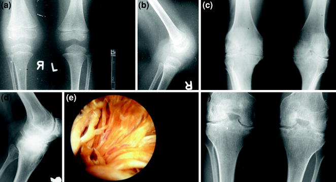 Articular Cartilage Defects of the Knee: Diagnosis and Treatment ...