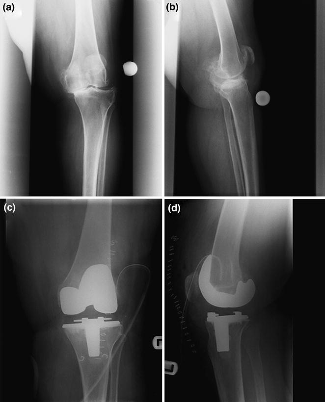 Articular Cartilage Defects of the Knee: Diagnosis and Treatment ...