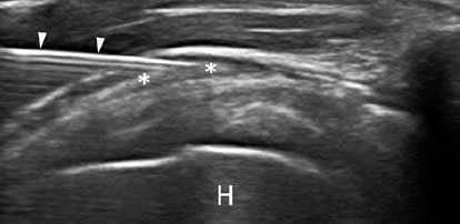 Calcific Enthesopathy Dry-Needling | SpringerLink