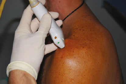 Acromioclavicular Joint Injection | SpringerLink