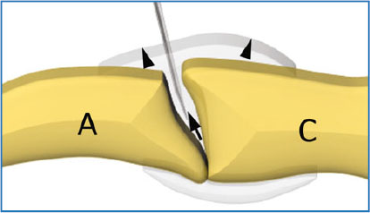 Acromioclavicular Joint Injection | SpringerLink
