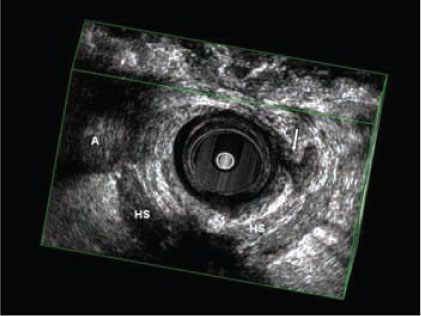 Cryptoglandular Fistulas | SpringerLink
