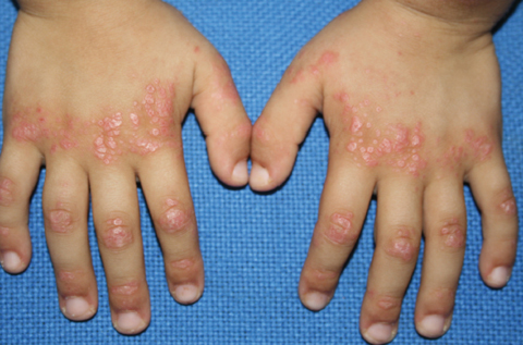 Connective Tissue Diseases | SpringerLink