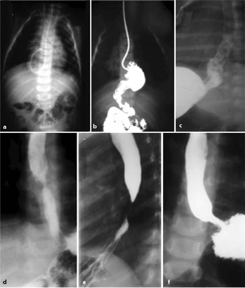 Gastroesophageal Reflux | SpringerLink
